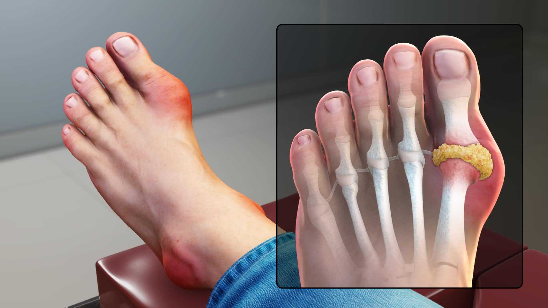 Gout VA Disability Berry Law Veterans Attorneys