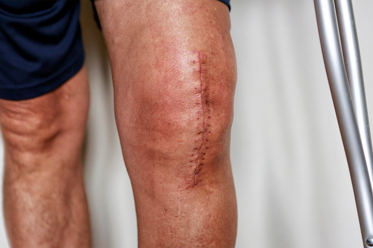 VA Disability Rating For Knee Replacement Surgeries Berry Law VA Disability Rating For Knee Replacement Surgeries Berry Law